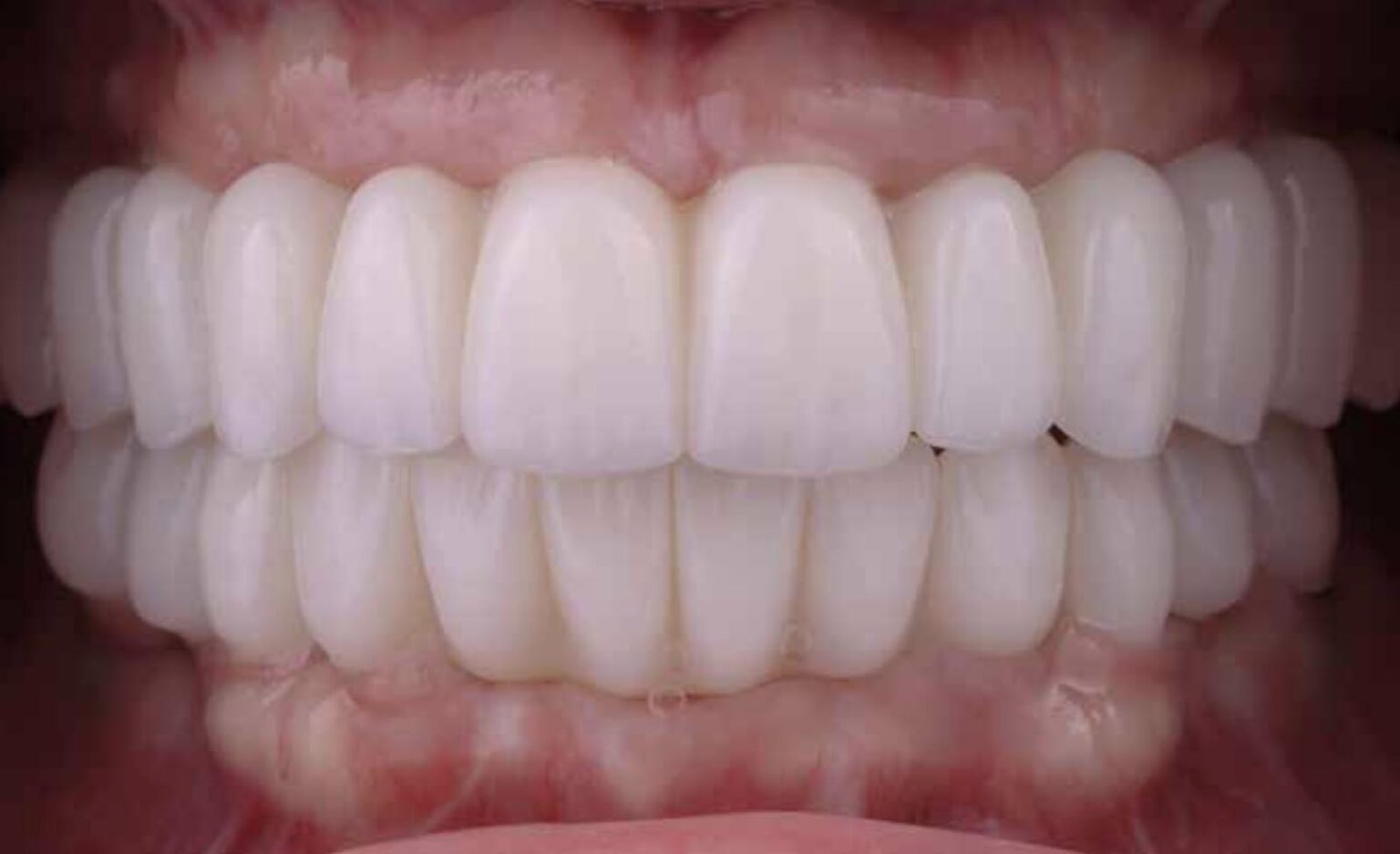 Everything You Need to Know About FP1 Full Arch Implants | Innova ...